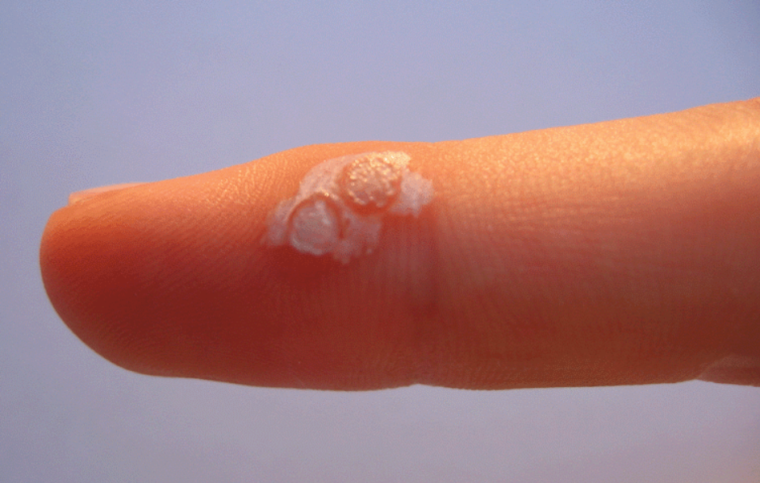 Usuwanie brodawek - Dermatolog Anna Neneman